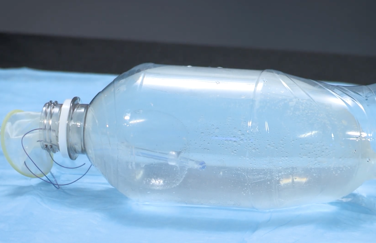Le tamponnement intra-utérin par ballonnet serait efficace pour ...