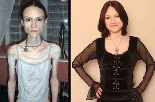 L’anorexie conduit à une perte de matière grise dans le cerveau